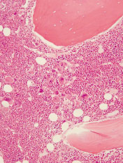 Diagnóstico diferencial de la Mielofibrosis